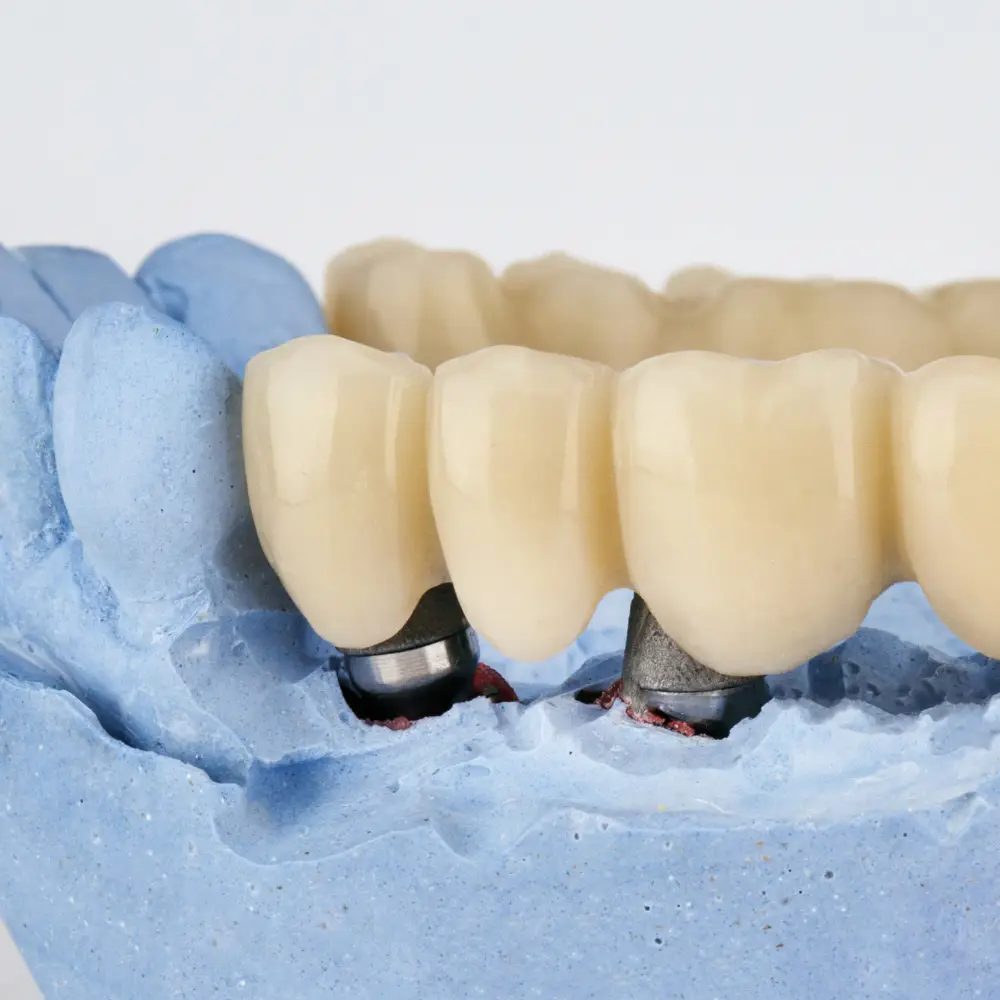 Prótese e Ponte - Felicity Odontologia Especializada